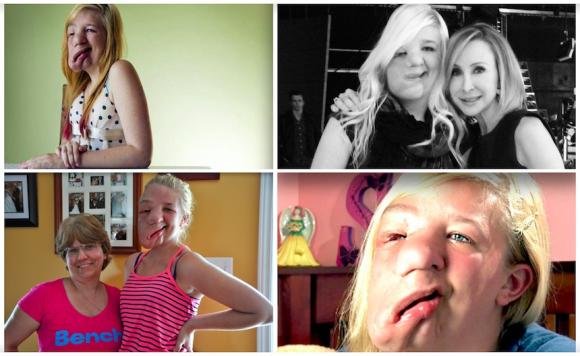 Sarah Atwell, la ragazza con il viso deformato