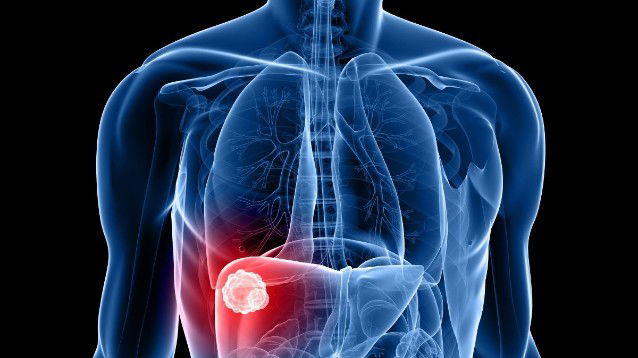 Cancro: i 6 sintomi da non sottovalutare per riconoscere in tempo la ...