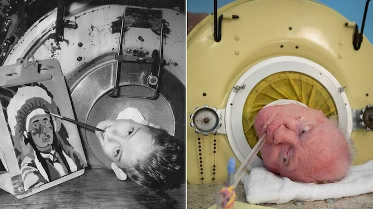 Muore Paul Alexander, l'uomo che ha vissuto per 70 anni nel polmone d ...