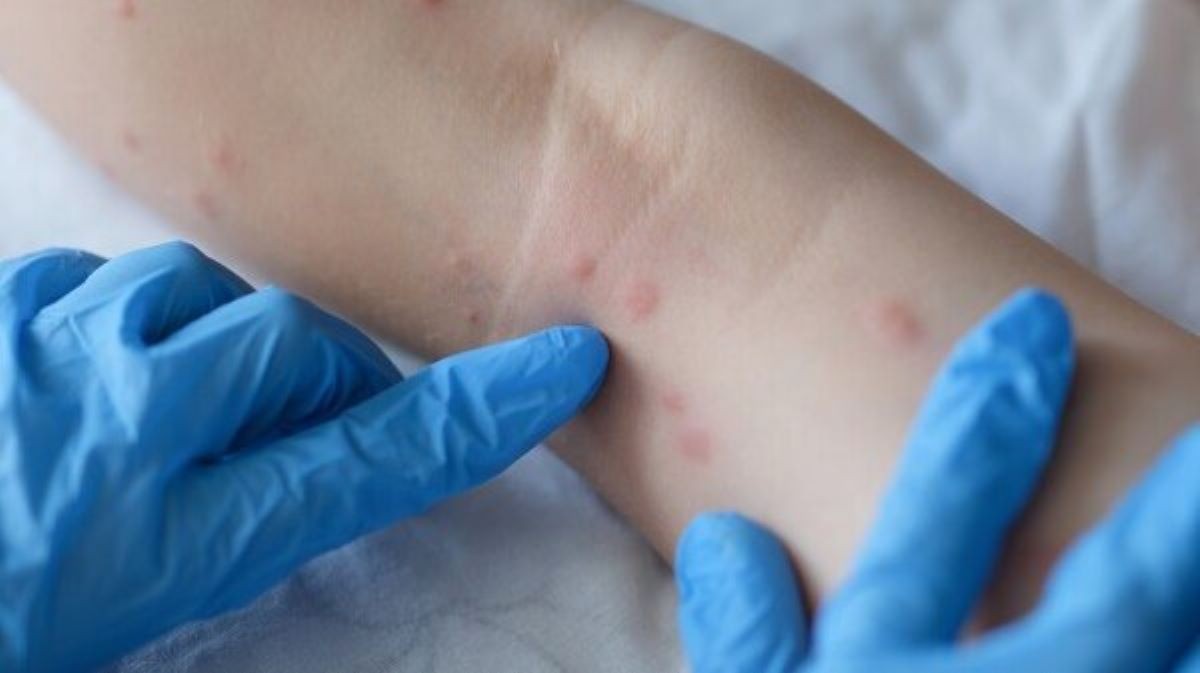 Infezione da stafilococco, sintomi e come riconoscerlo