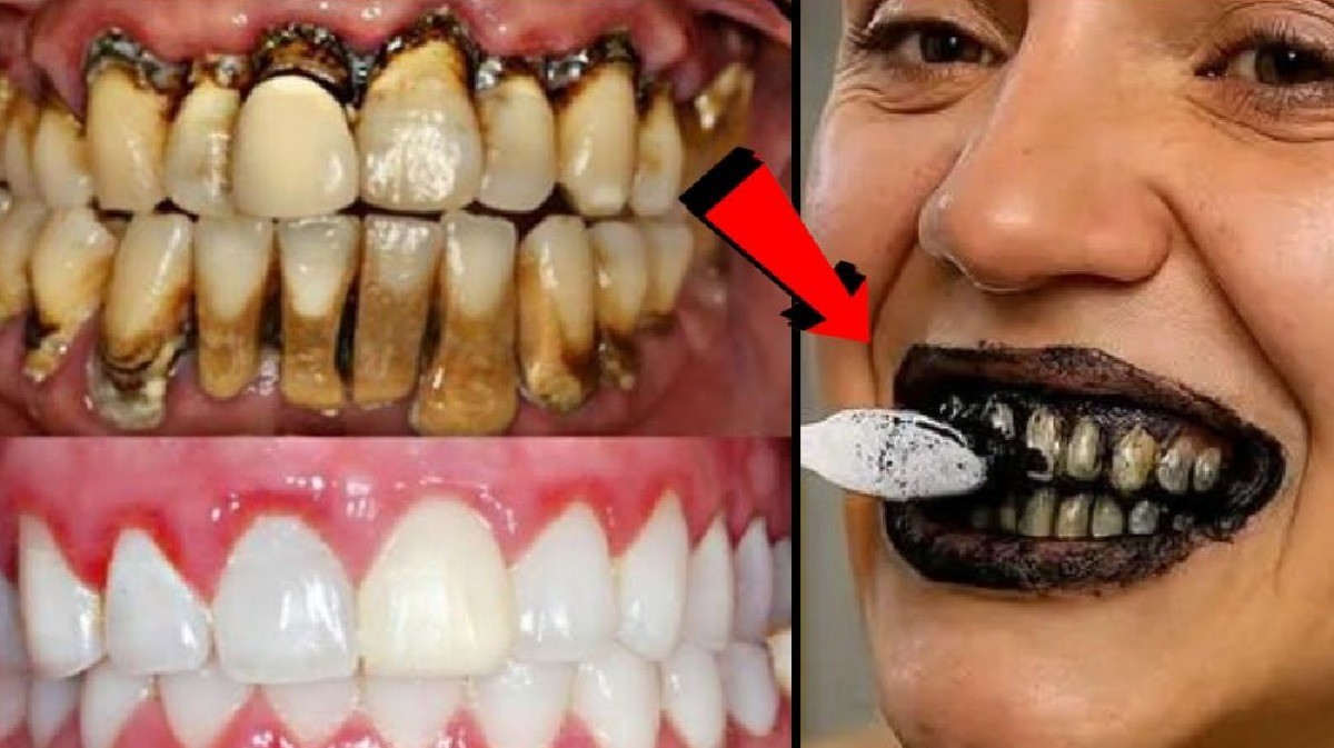 Il trucco infallibile di come riparare i denti in modo naturale
